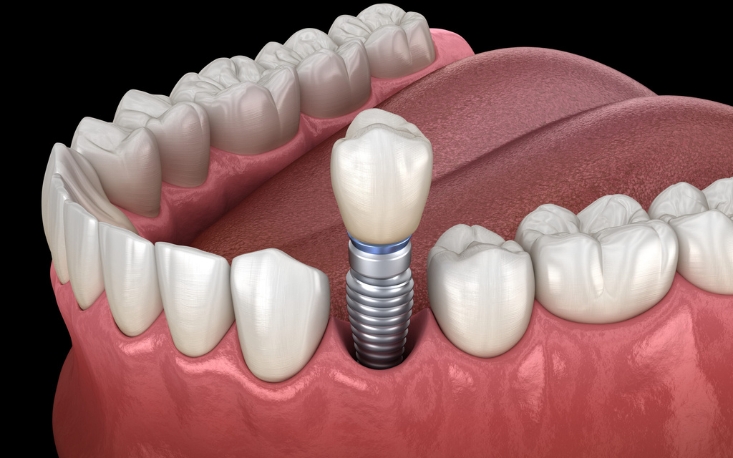 Ways To Maintain Your Dental Implants for Life